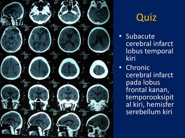 Baca ct scan | PPTX