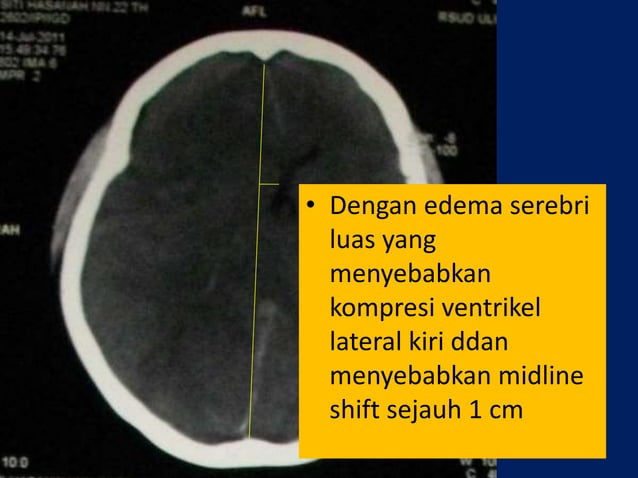 Baca ct scan | PPTX