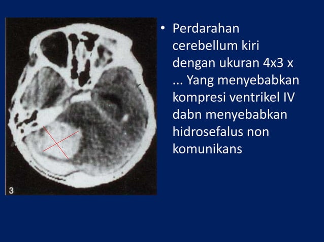 Baca ct scan | PPTX