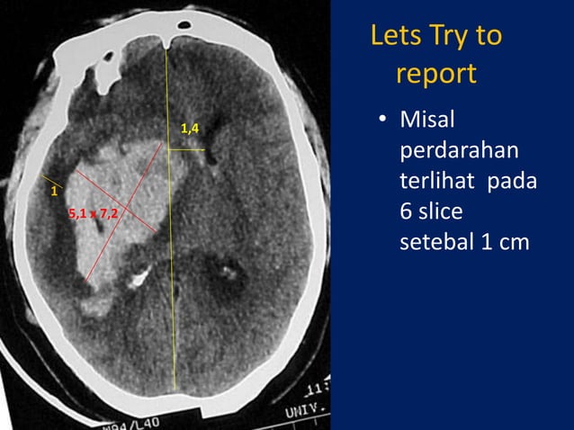Baca ct scan | PPTX