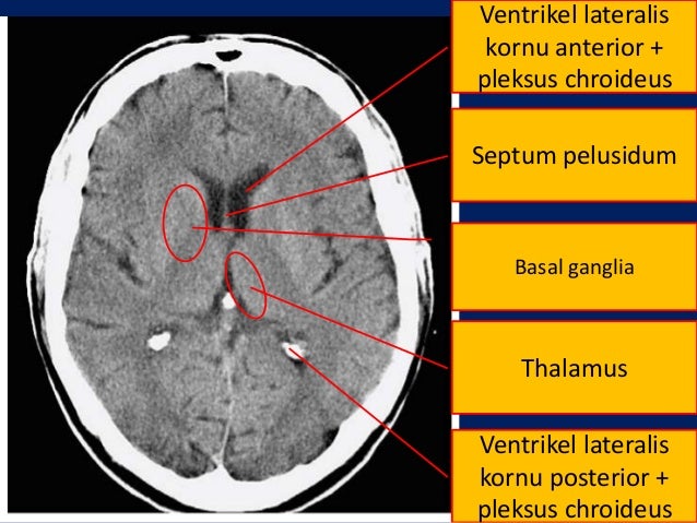Baca ct scan