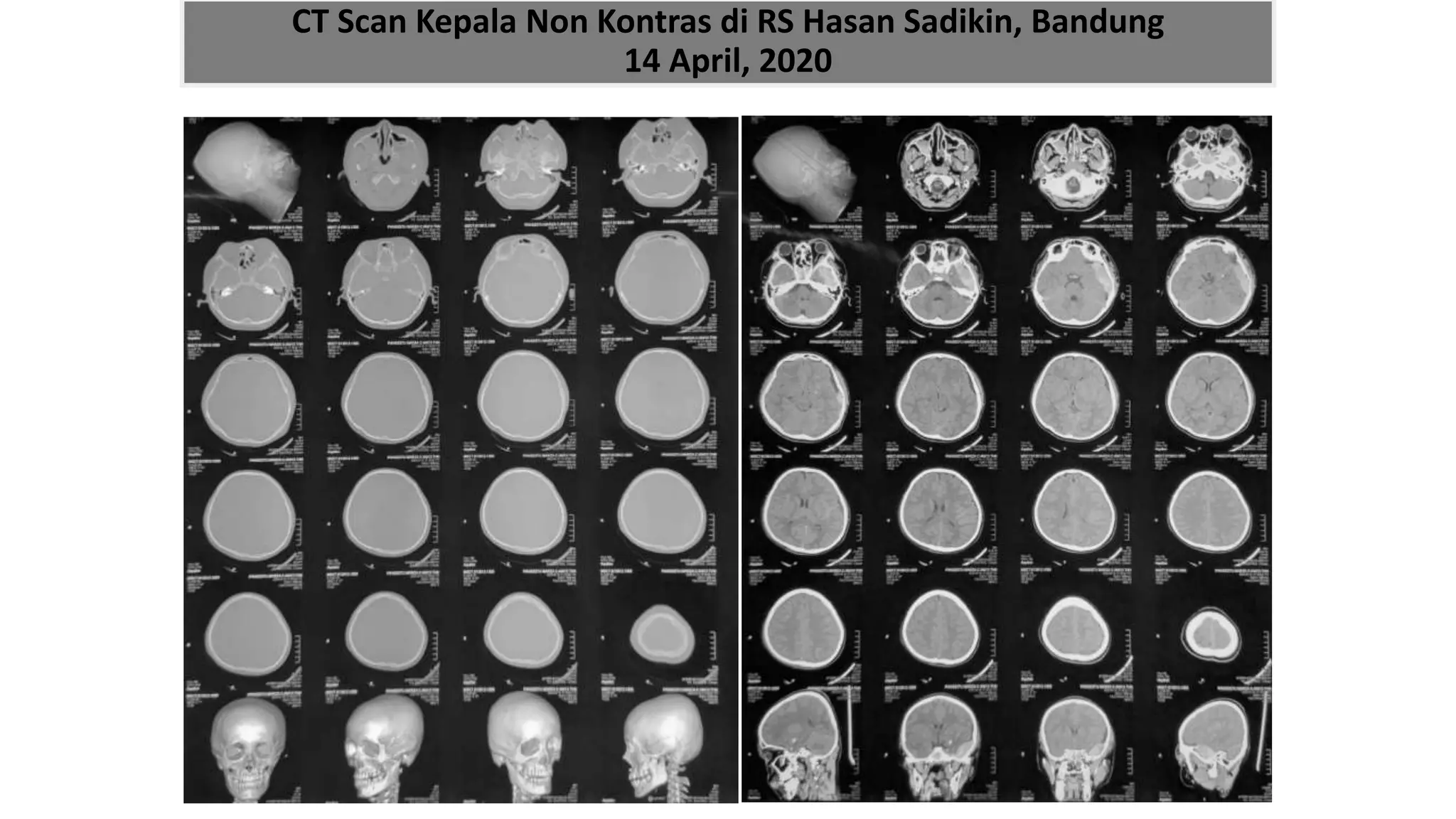 Baca CT Scan - NR (1).pptx