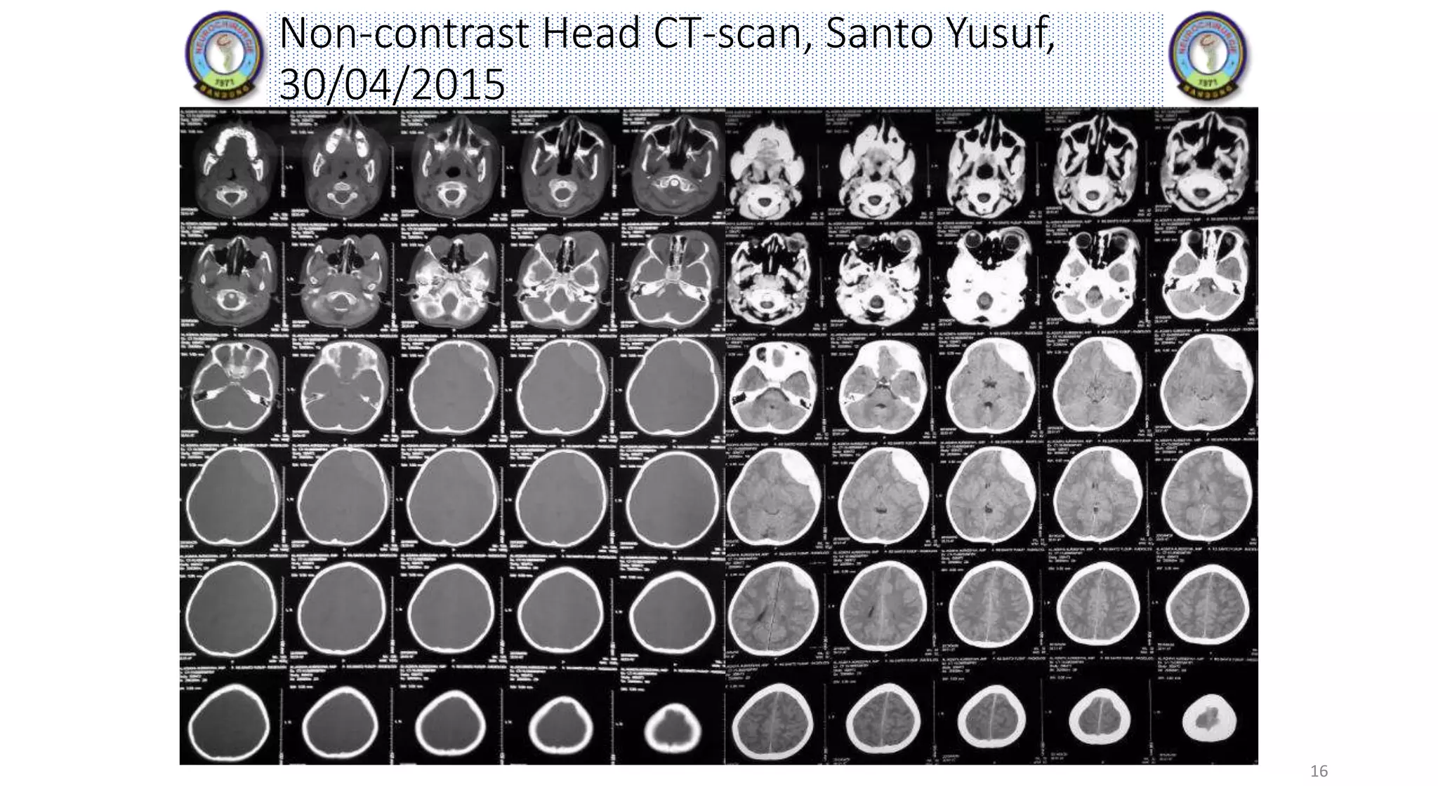 Baca CT Scan - NR (1).pptx