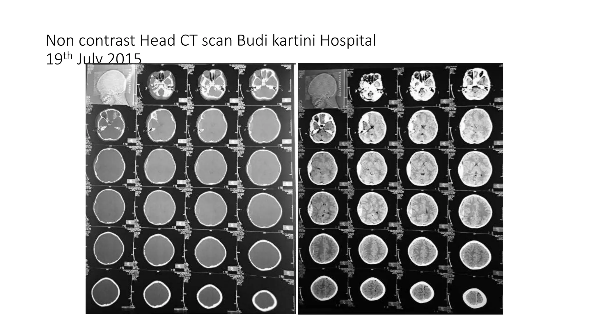 Baca CT Scan - NR (1).pptx