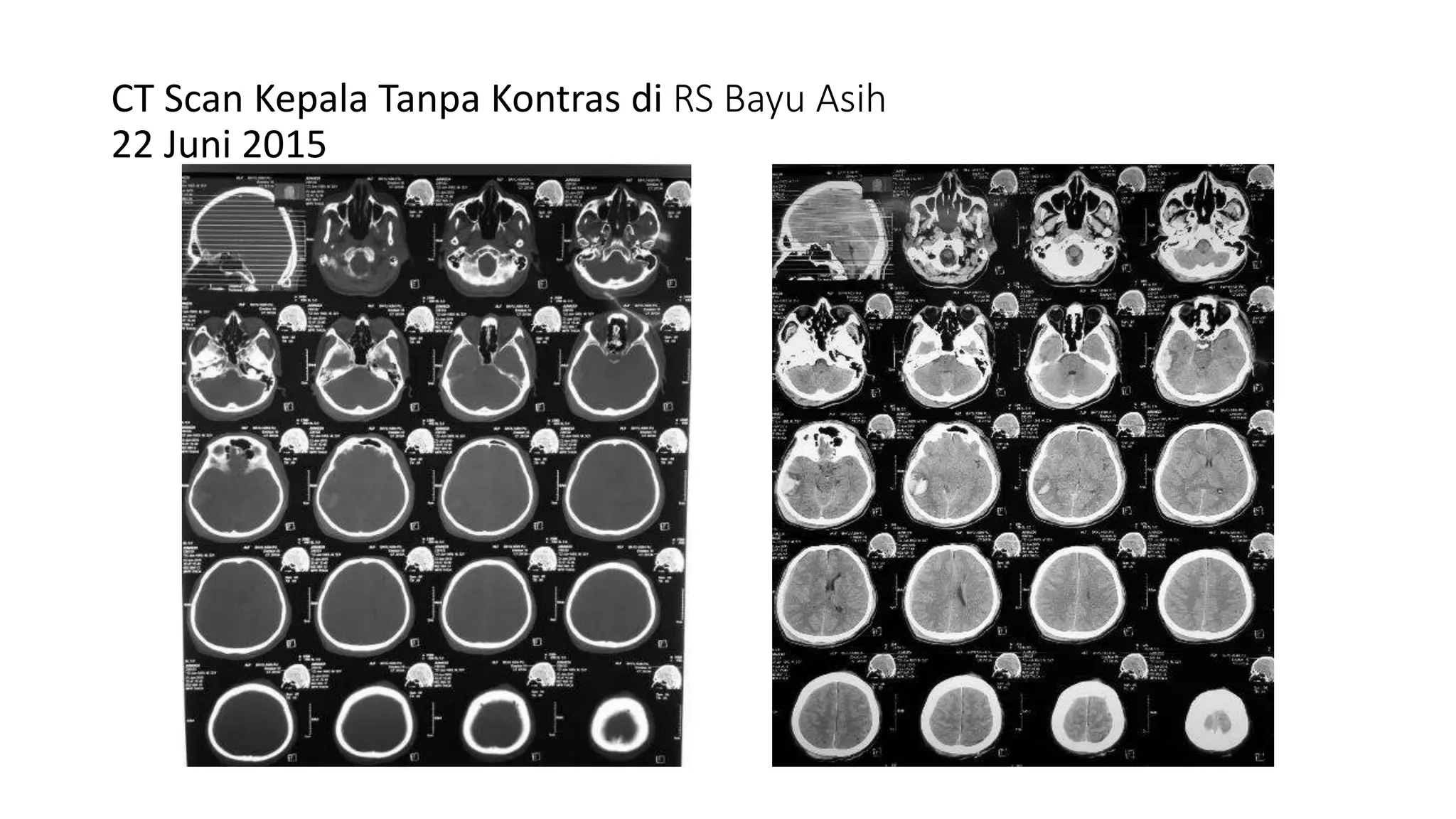Baca CT Scan - NR (1).pptx