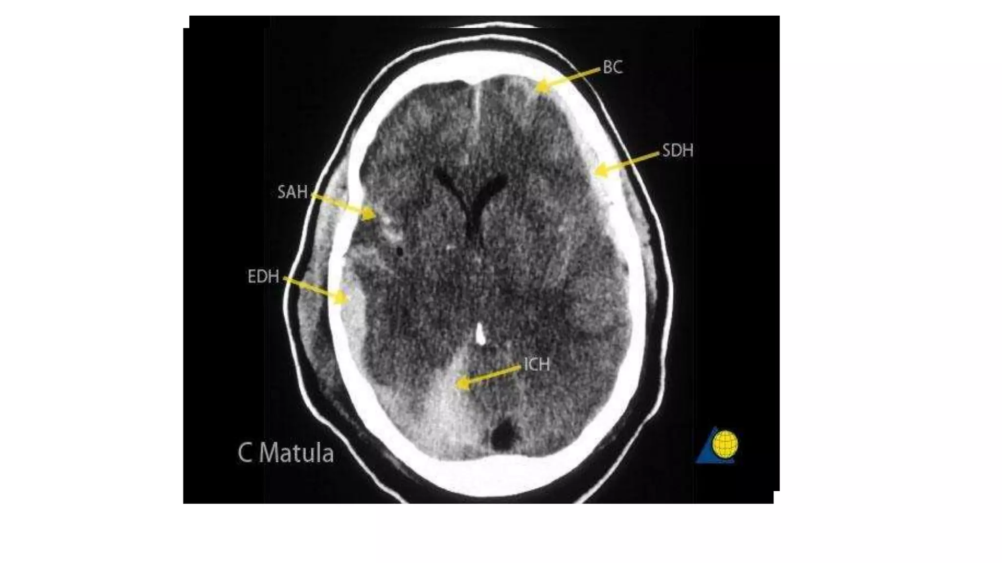 Baca CT Scan - NR (1).pptx