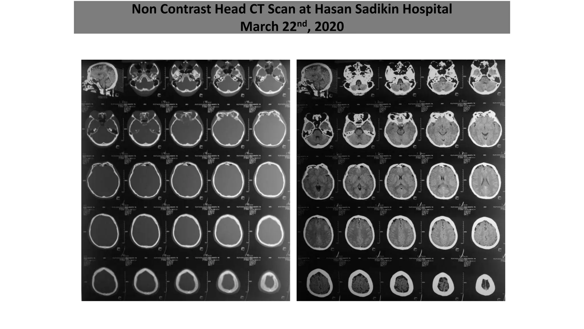 Baca CT Scan - NR (1).pptx