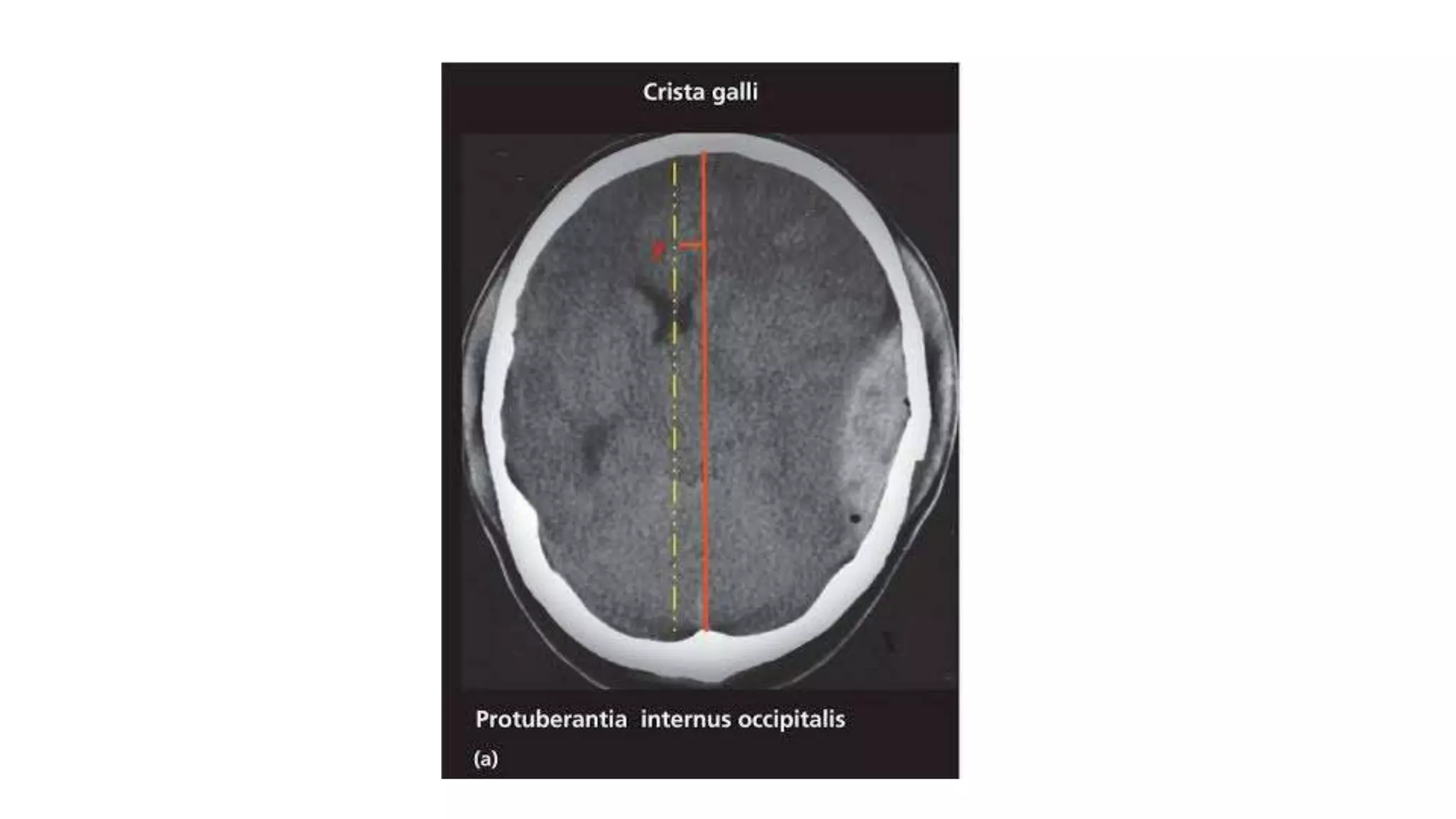 Baca CT Scan - NR (1).pptx