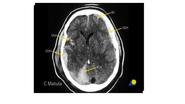 Baca CT Scan - NR (1).pptx | Death, Injury, or Military Conflict | Sensitive Topics