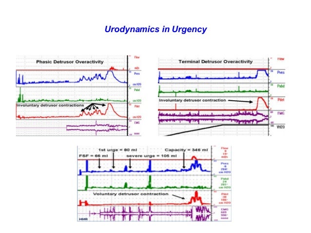 Making sense of Urodynamic studies for women with Urinary Incontine…