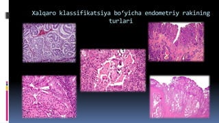 Bachadon endometriysi raki | PPTX