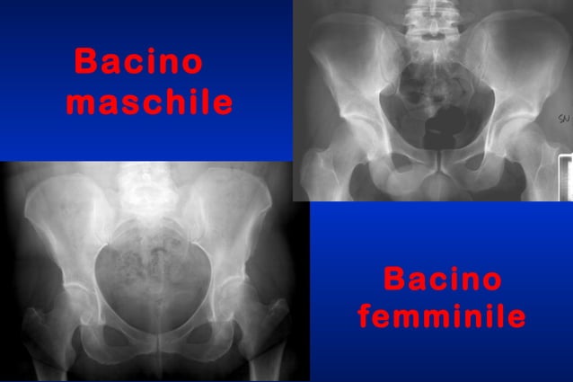 RADIOLOGIA STANDARD E PATOLOGICA DEL BACINO | PPT | Bone and Joint ...