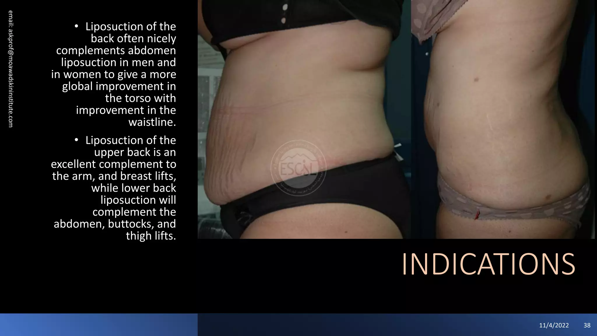 Back Liposuction.pptx | Cosmetic Medical Services | Medical Health