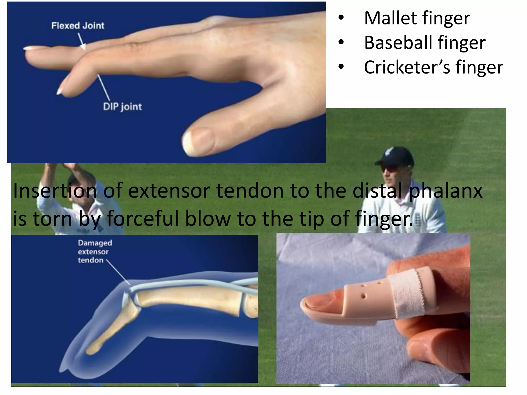 Anatomy of Back of fore arm and dorsum of hand | PDF