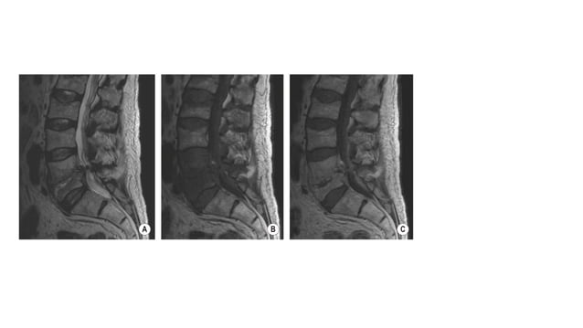 Back pain emergency | myelopathy | radiculopathy | | PPT