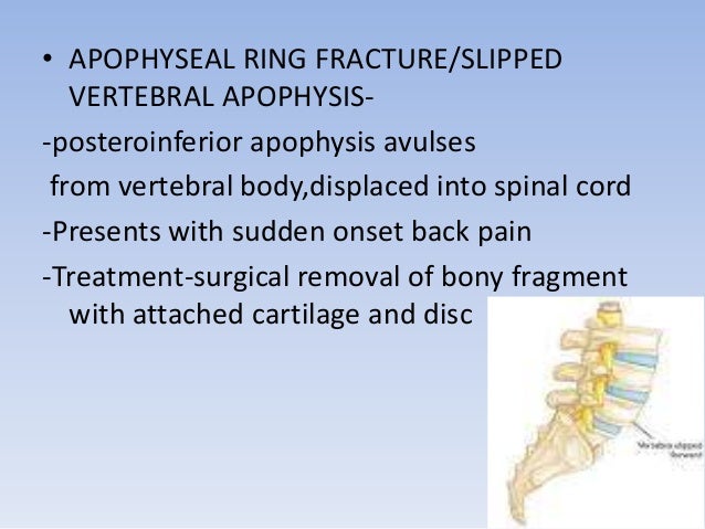 Back pain in children