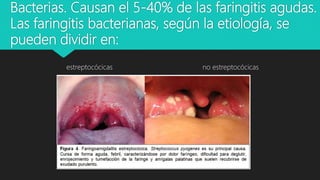Faringitis o faringoamigdalitis | PPTX