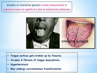 bacterial infections and their oral manifestations | PPTX