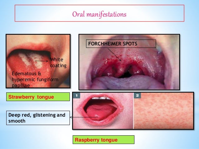 bacterial infections and their oral manifestations