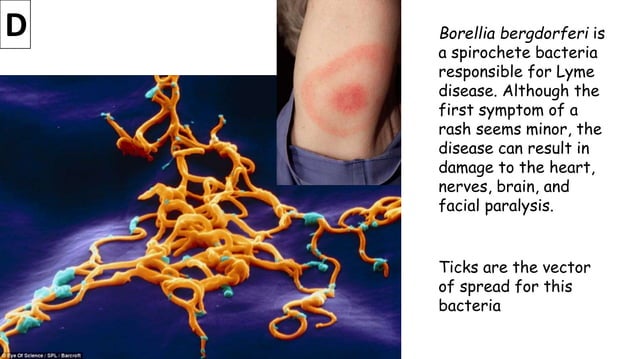Bacteria Disease Examples | PPTX | Infectious Diseases | Diseases and ...