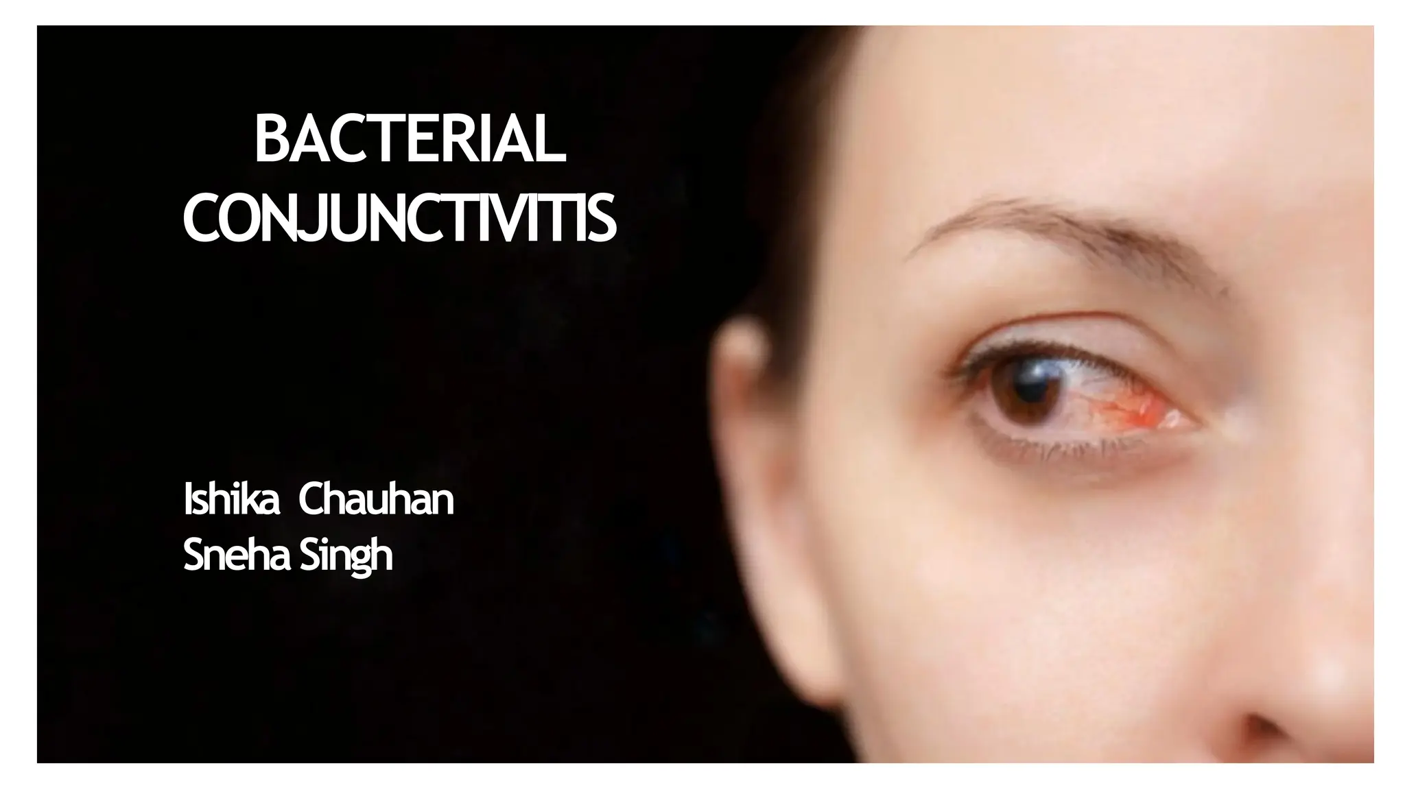 Conjuctiva bacterial eye type of conjunctivitis .pptx