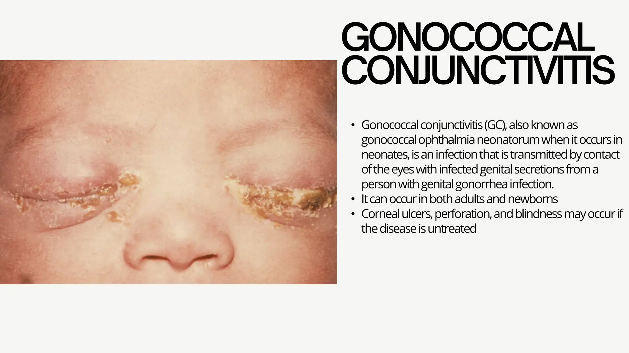 bacterial-infections eyes related infections | PPTX