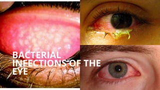 bacterial-infections eyes related infections | PPTX | Eye and Vision ...