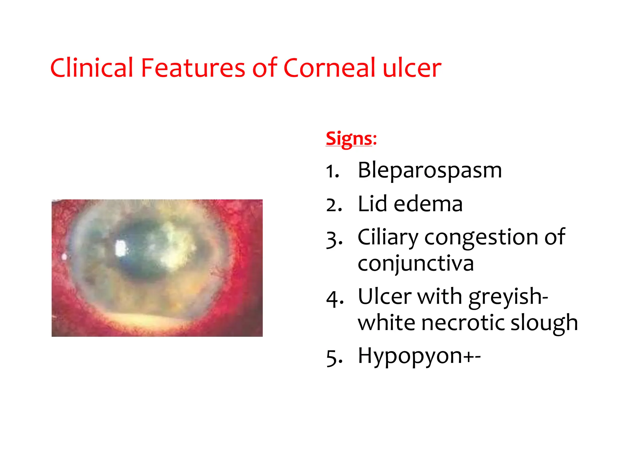 Bacterial and fungal corneal ulcer.pptx for under graduates and ...