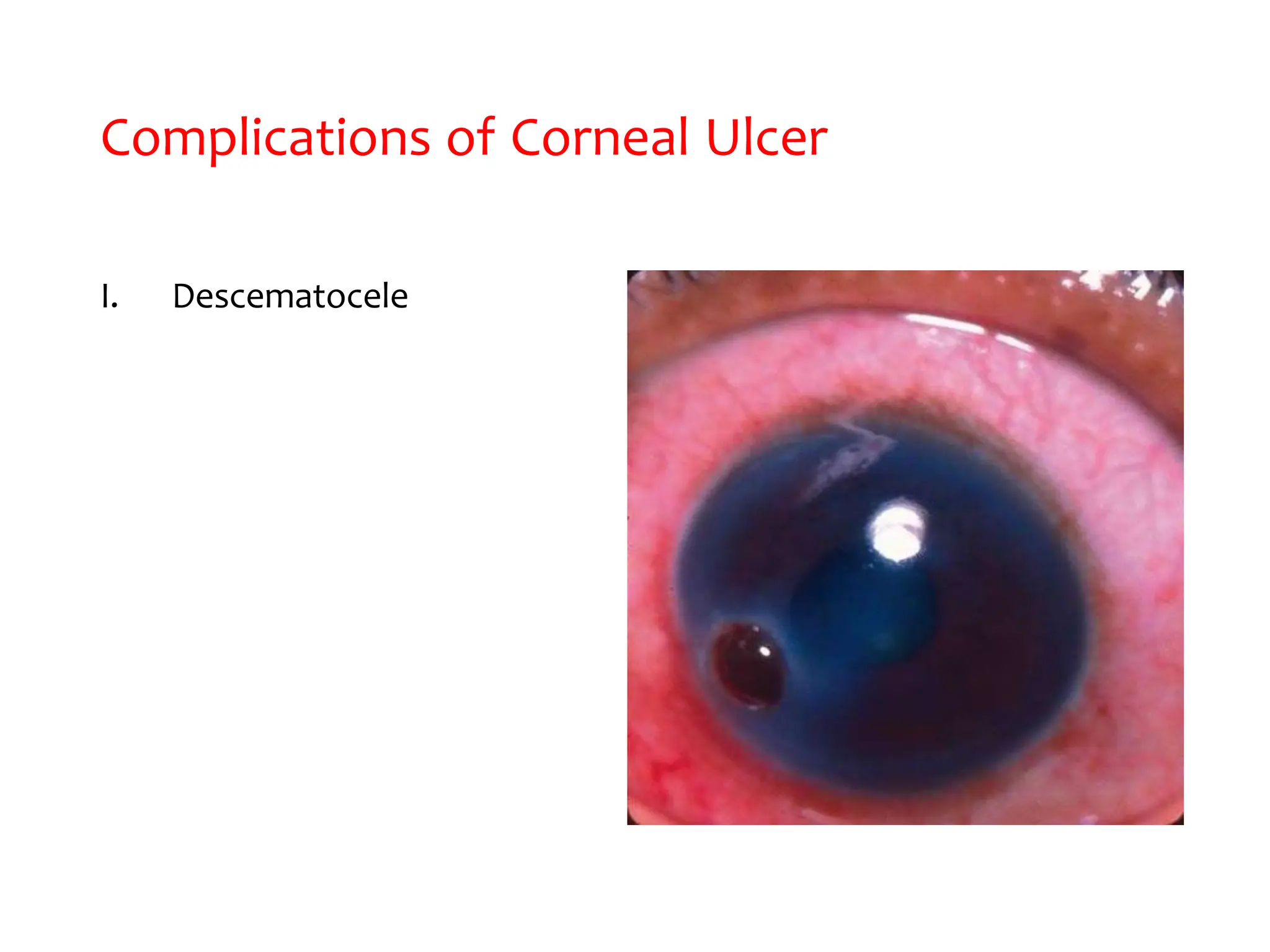 Bacterial and fungal corneal ulcer.pptx for under graduates and ...