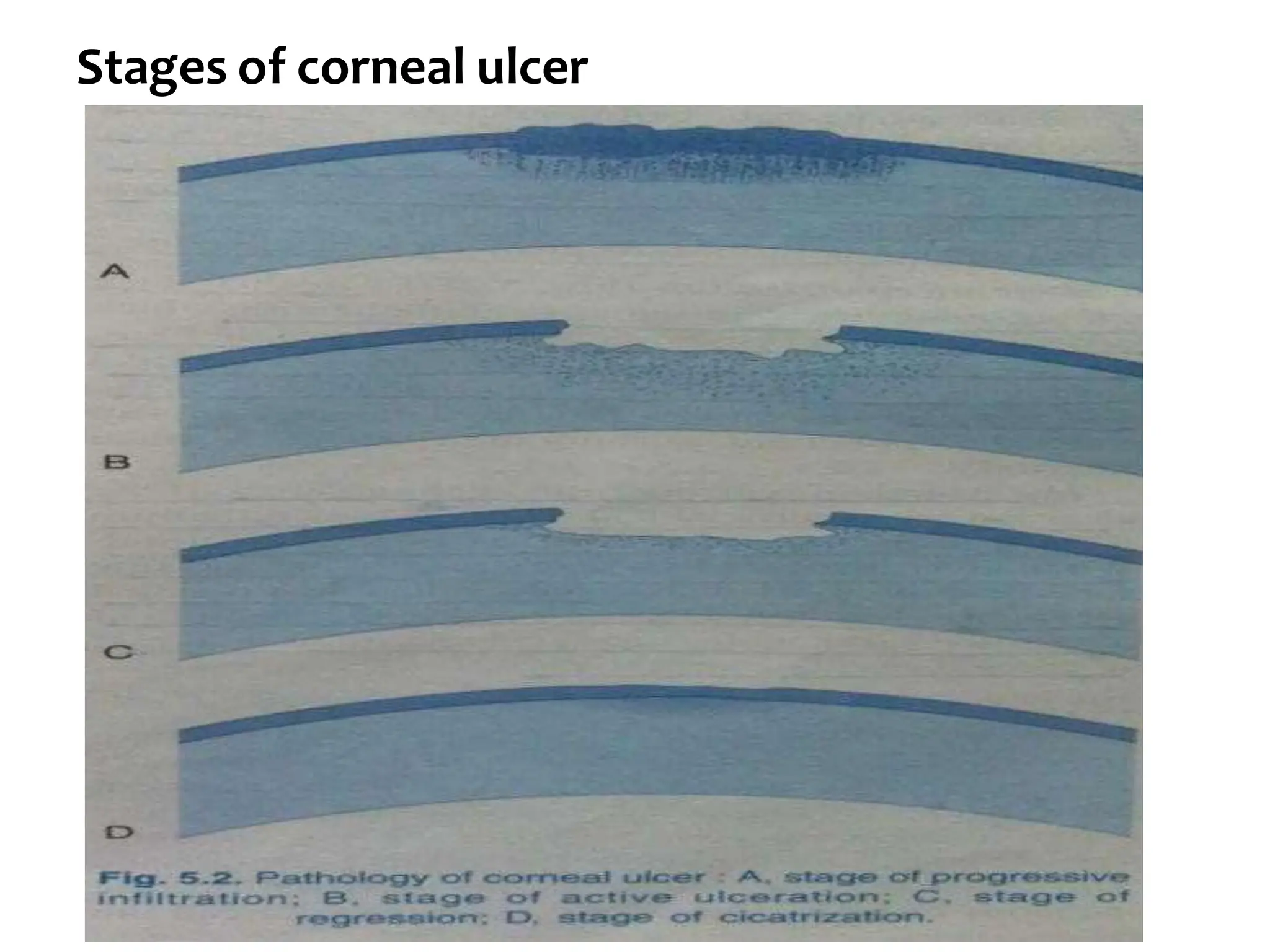Bacterial and fungal corneal ulcer.pptx for under graduates and ...