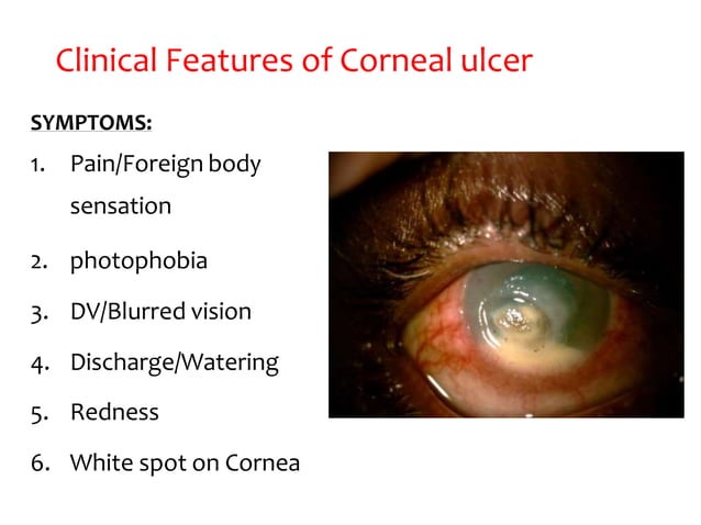 Bacterial and fungal corneal ulcer.pptx for under graduates and ...