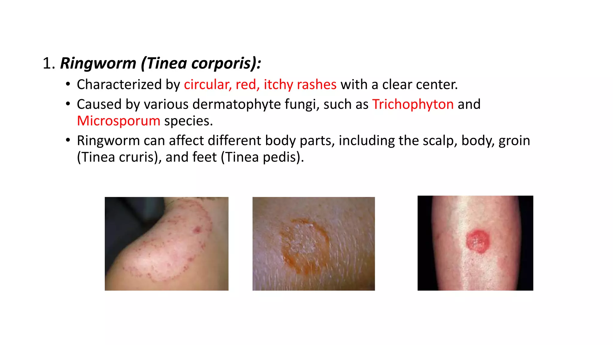 Bacterial and Fungal Skin Diseases.pptx