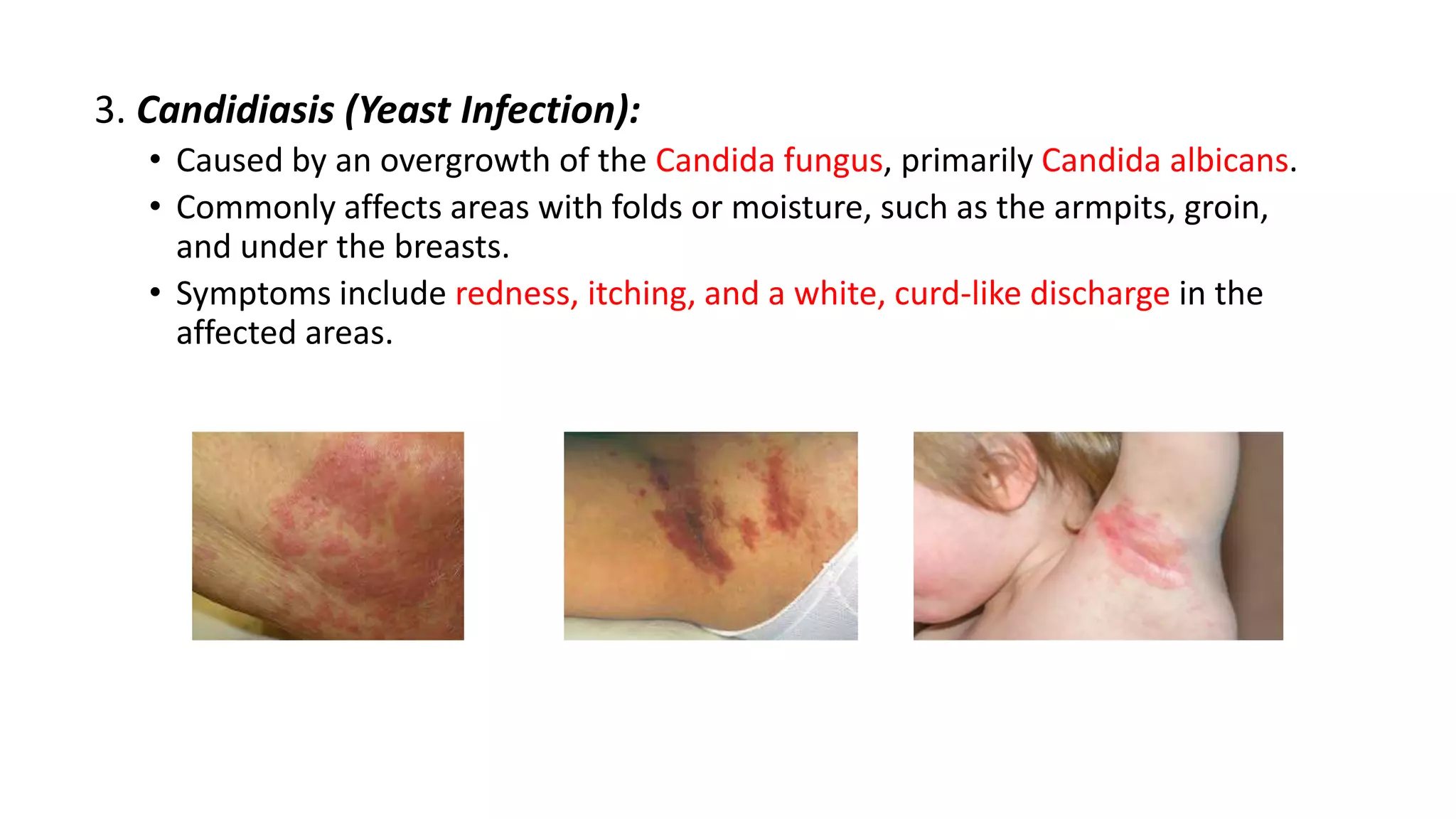 Bacterial and Fungal Skin Diseases.pptx