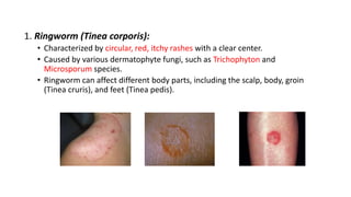 Bacterial and Fungal Skin Diseases.pptx