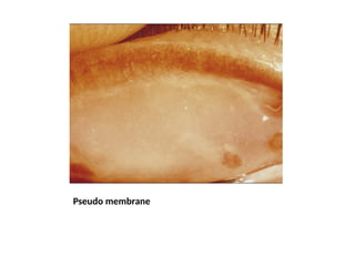 bacterial_and_viral_conjunctivitis.pptx1 | PPTX