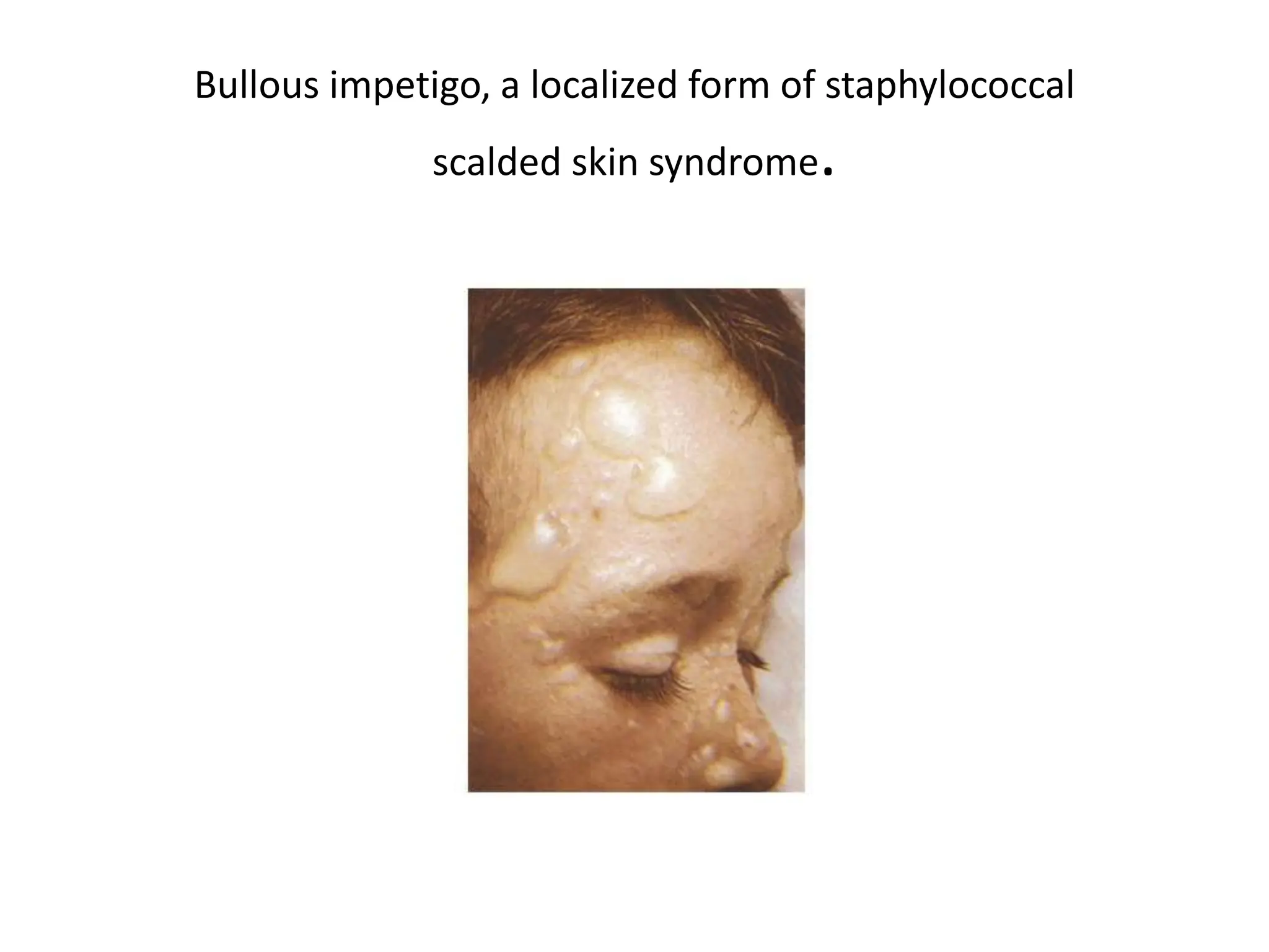 Bacterial and Viral skin infection.pptx