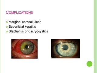 Bacterial conjunctivitis Pharmacotherapy | PPTX