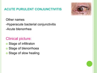 Bacterial conjunctivitis Pharmacotherapy | PPTX