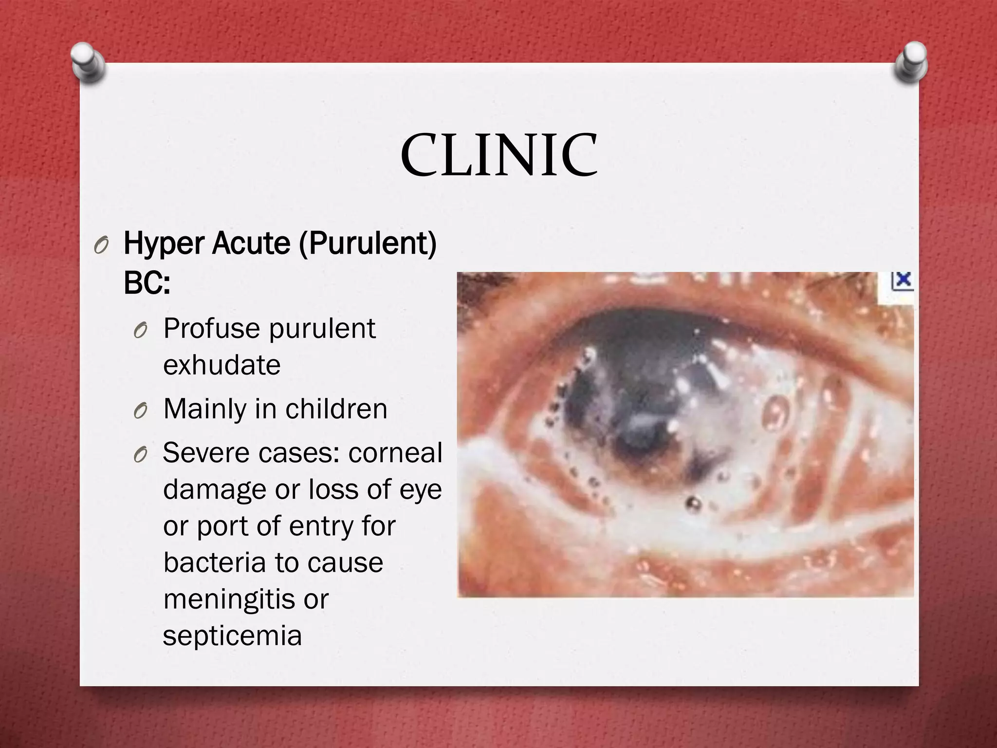 Bacterial conjunctivitis | PDF