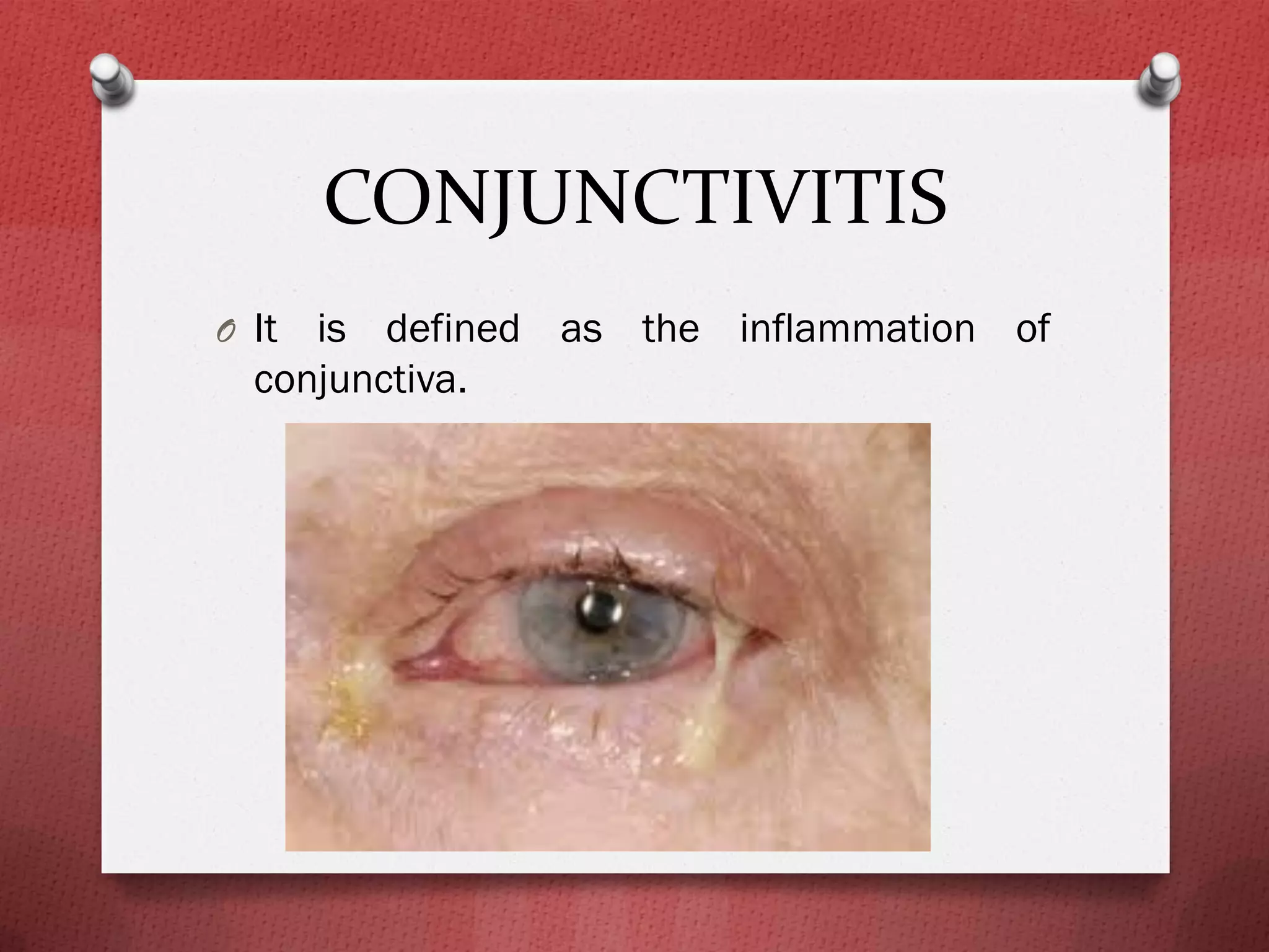 Bacterial conjunctivitis | PDF
