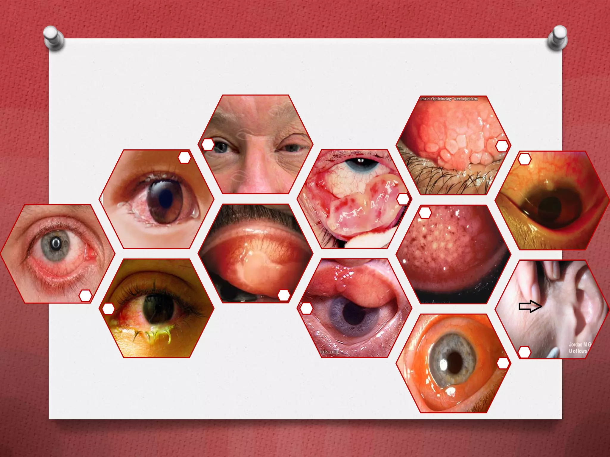Bacterial conjunctivitis | PDF