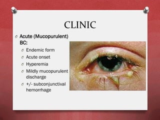 Bacterial conjunctivitis | PDF