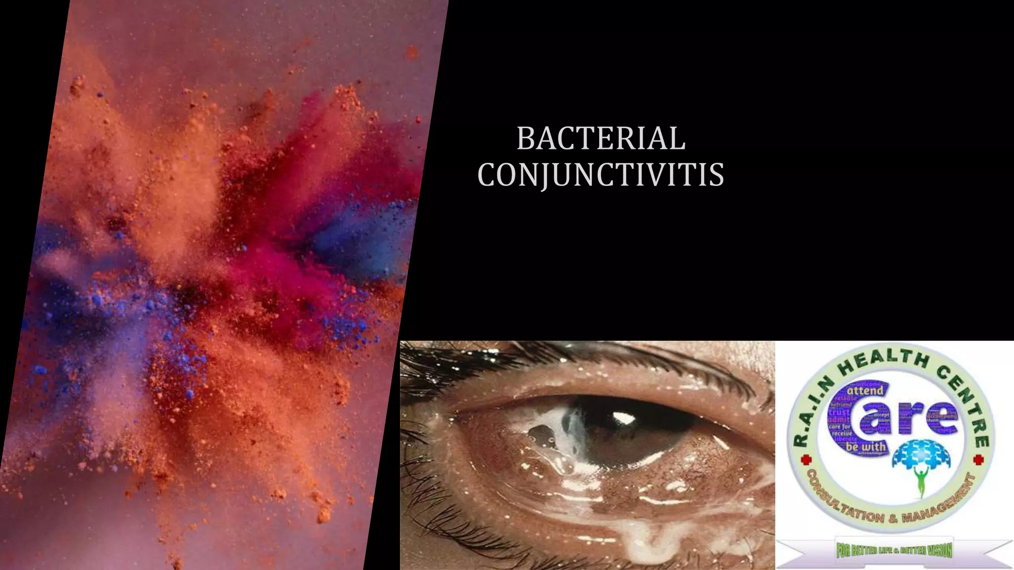Bacterial conjunctivitis | PPT