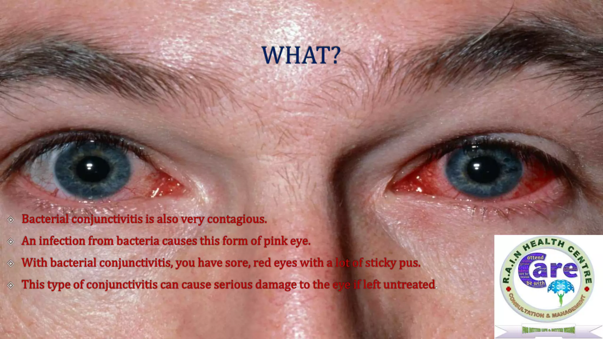 Bacterial conjunctivitis | PPT