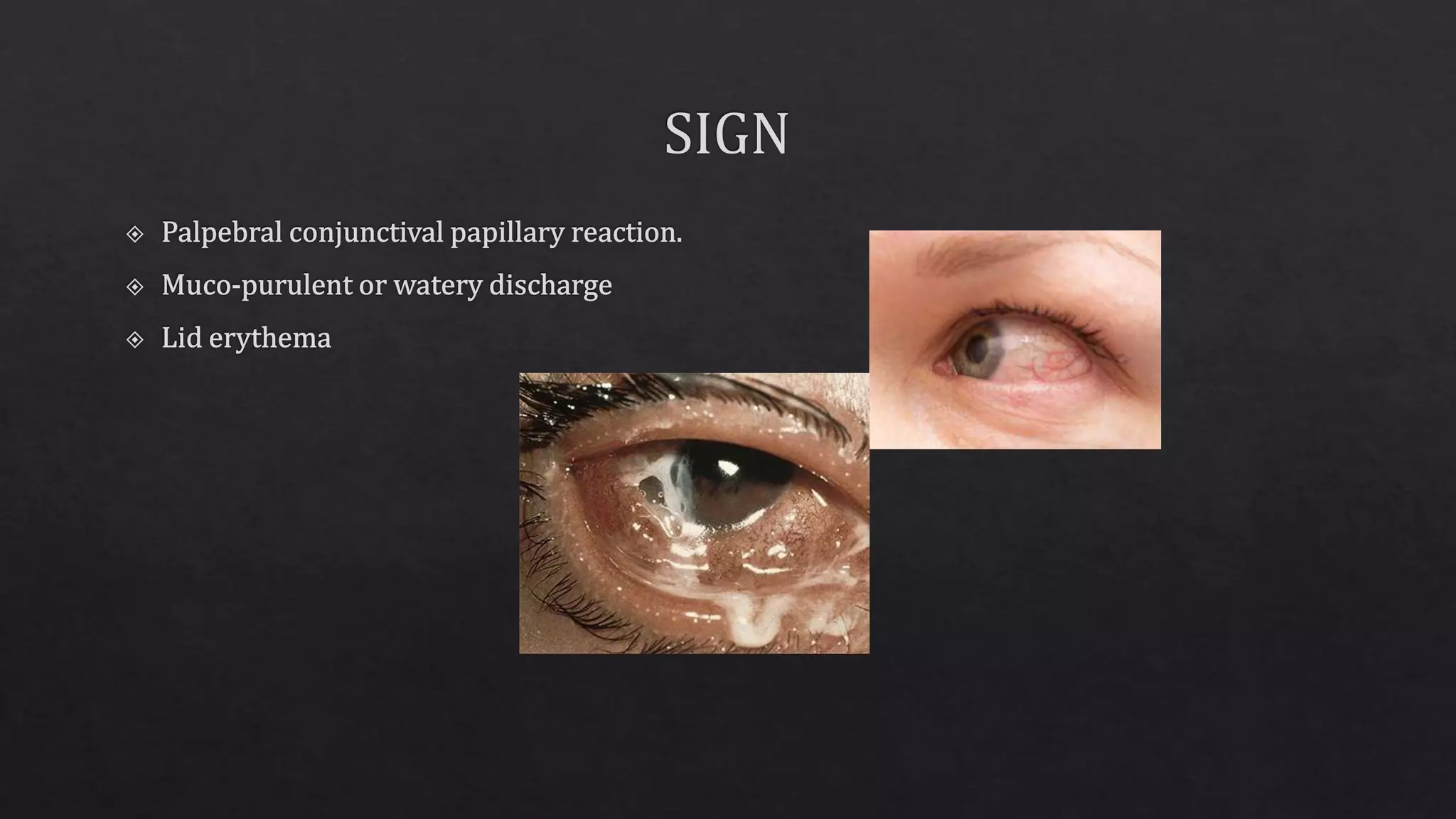 Bacterial Conjunctivitis Ppt
