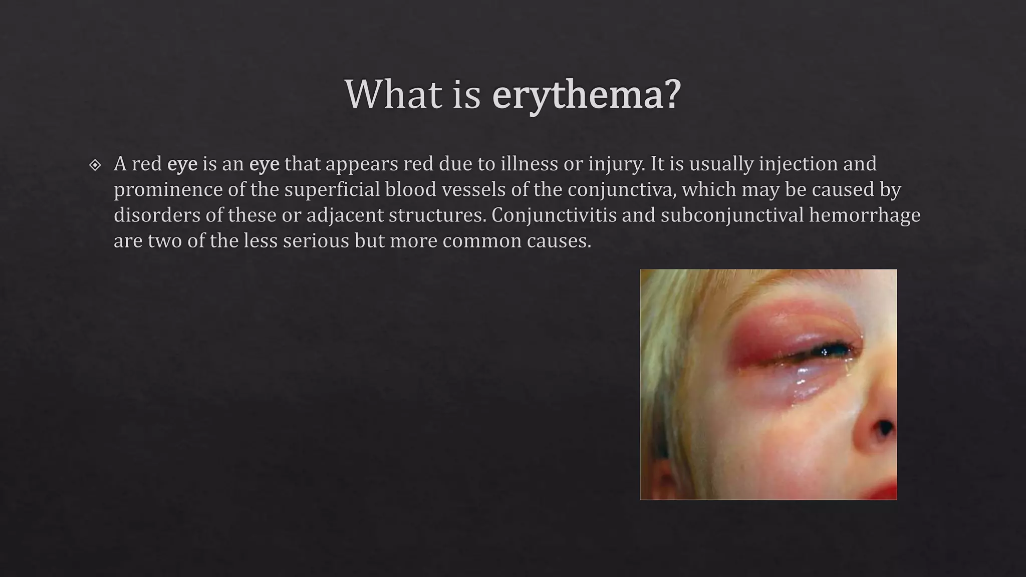 Bacterial Conjunctivitis Ppt