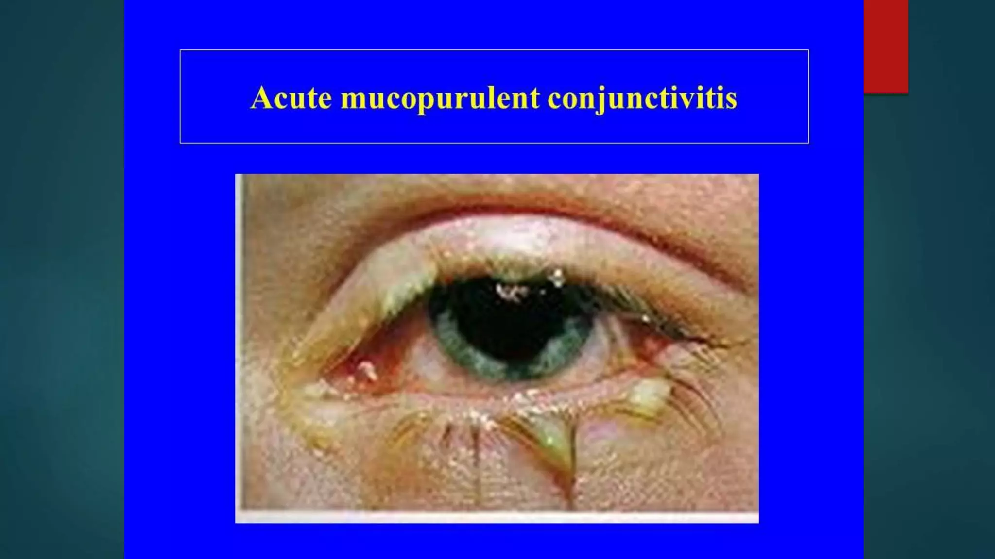 Bacterial conjunctivitis | PPTX