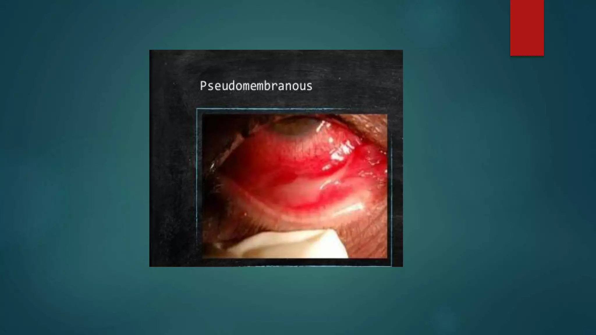 Bacterial conjunctivitis | PPTX