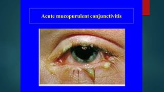 Bacterial conjunctivitis | PPTX
