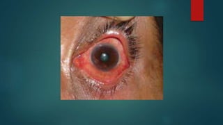 Bacterial conjunctivitis | PPTX
